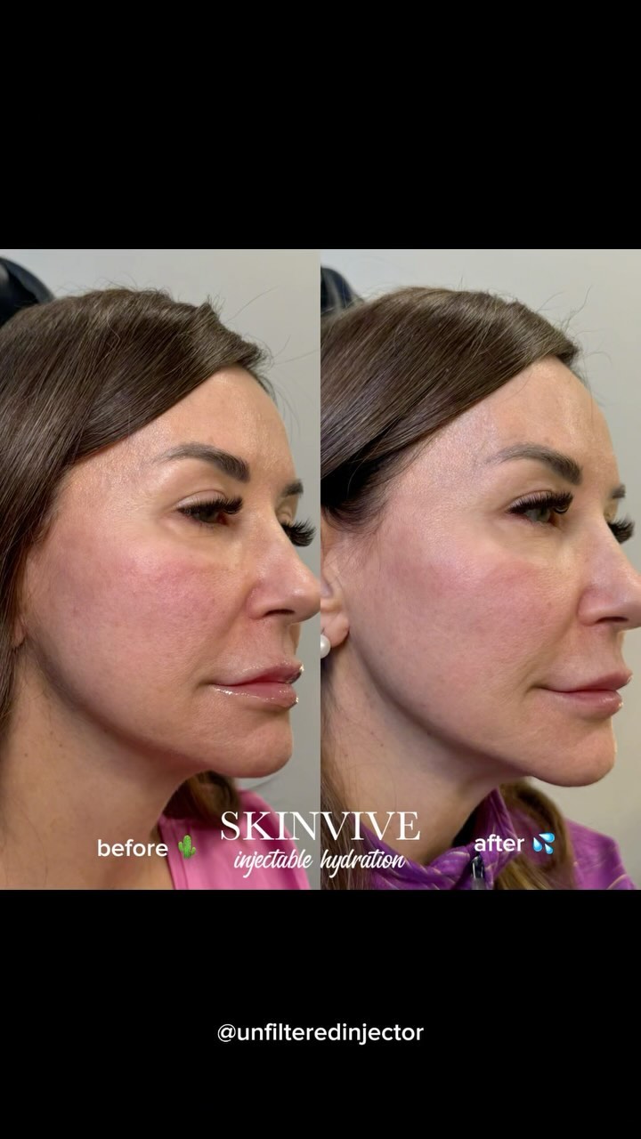 Your Easy Guide to Find the Best Botox Injector in Virginia - Dontage