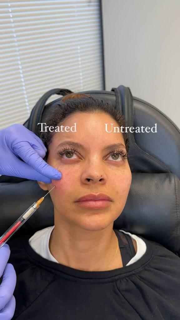 EZ PRF Gel Injectable (Plasma Rich Fibrin) - Dontage